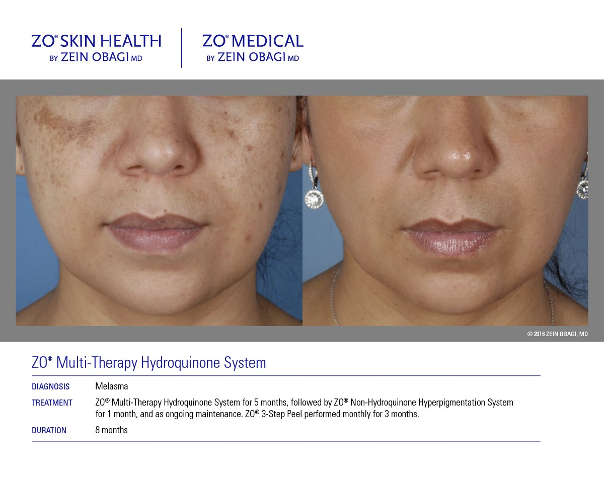 ZO® 3 - STEP PEEL™ Glendale, AZ | Phoenix | Paul Angelchik, MD